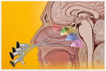 Endoscopic Skull Base Surgery Tampa FL, Nasal & Sinus Services